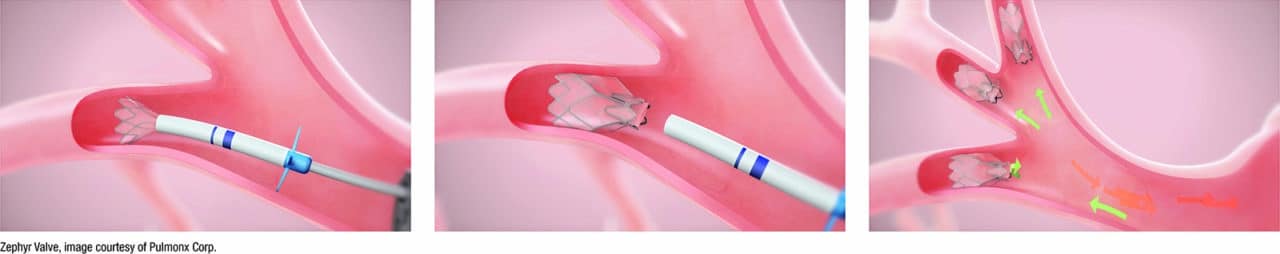 Zephyr Valve – Med Center Health