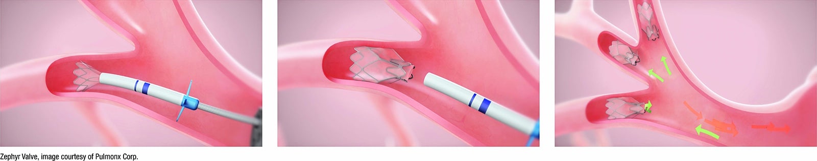 Zephyr Valve – Med Center Health