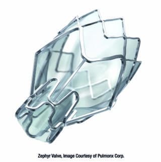 Zephyr Valve – Med Center Health